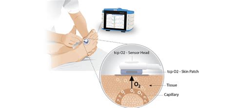 Transcutaneous Oximetry Tcom By Perimed Skinobs