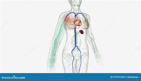 Lymphedema By Post Axillary Lymph Node Dissection Stock Illustration Illustration Of Nose