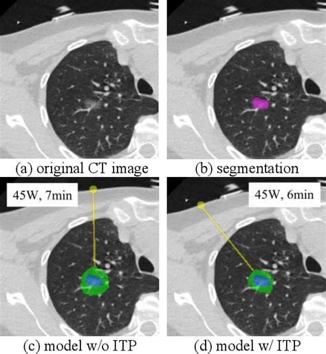 Figure 4 From Integrated Treatment Planning In Percutaneous Microwave Ablation Of Lung Tumors