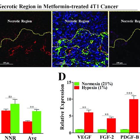 Hypoperfusion Resulted In Tumor Necrosis And Hypoxia Associated Download Scientific Diagram