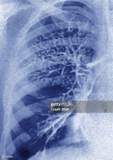Bronchiectasis X Ray Bronchial Dilatation Pulmonary X Ray In Front News Photo Getty Images