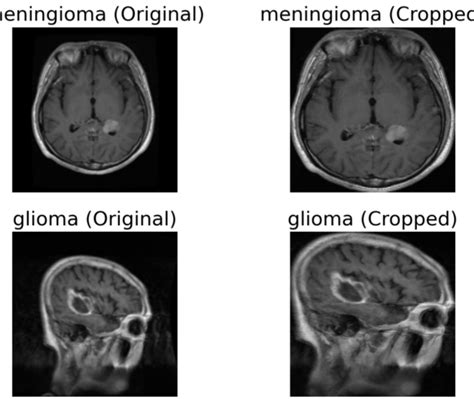 논문 리뷰 Light Weight Cnn For Classification Of Brain Tumors From Mri Images