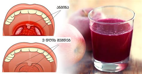 როგორ მოვირჩინოთ ანგინა საშინაო პირობებში ანტიბიოტიკების გარეშე სასარგებლო რჩევები