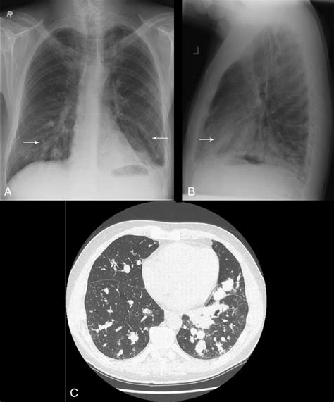 Mucus In Lungs X Ray