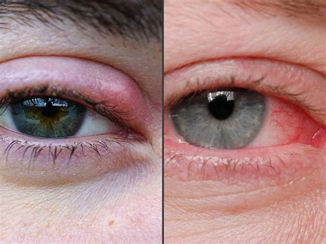 Stye Vs Pink Eye Understanding The Key Differences Qkzizv