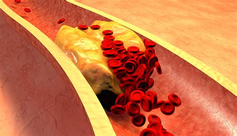 Temple Led Research Team Finds Sex Based Differences In Utilization And Outcomes For Catheter