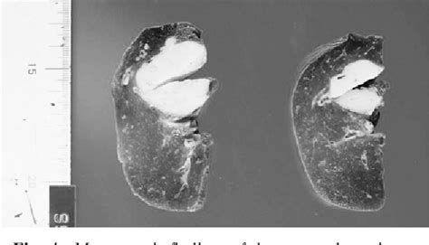 Figure 4 From A Case Of Thoracoscopic Left Lower Lobectomy For Pulmonary Granular Cell Tumor