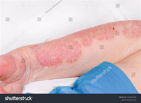 Acute Psoriasis On Arm Man Severe Stock Photo Shutterstock