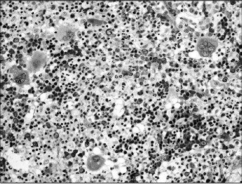 Bone Marrow Biopsy Findings The Marrow Revealed Hypercellularity Download Scientific Diagram