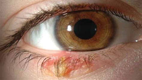 Optician Online Cpd Archive
