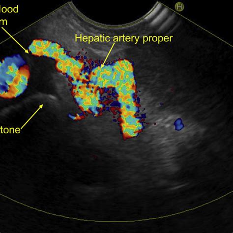 Linear Eus From Duodenal Bulb Showing Pseudoaneurysm Cbd Common Bile