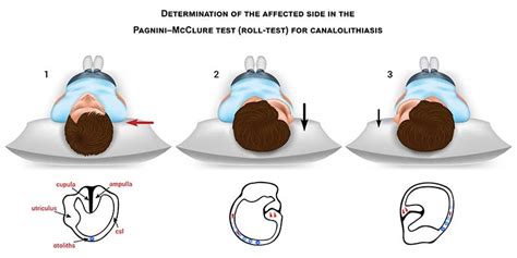 Horizontal Canal Bppv Diagnosis And Treatment
