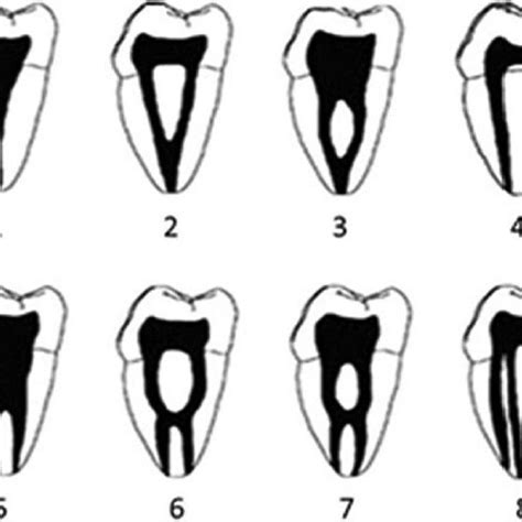 The Vertucci Classification Of Root Canal Configurations Download