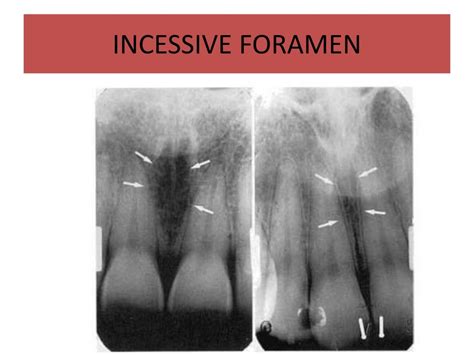 Intermaxillary Suture Radiograph