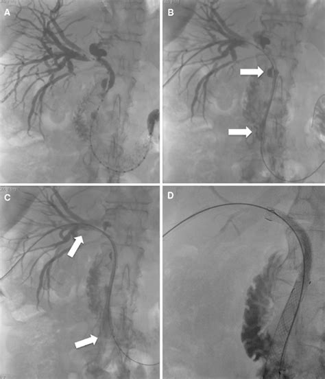 A Cholangiography In A 65 Year Old Female Patient With Download Scientific Diagram