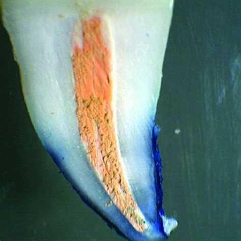 Apical Dye Leakage After The Crown Down Preparation Technique And Download Scientific Diagram