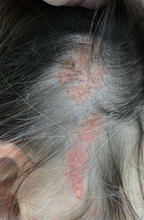 Epidermal Nevus Scalp