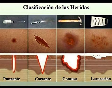 ⭕ ClasificaciÓn De Las Heridas🔼 Una Rinconada En Acción Facebook
