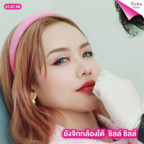 Barbie Lips ฟิลเลอร์ปาก ทรงยอดฮิตสไตล์สายฝอ Ticha Clinic