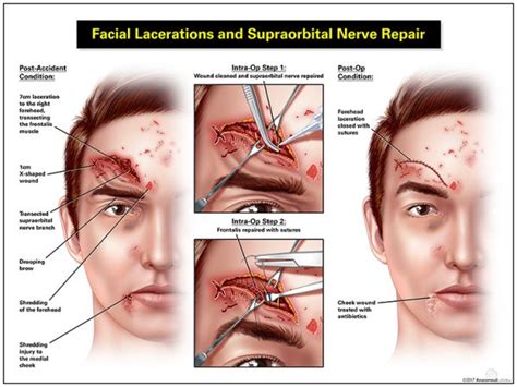 Facial Lacerations And Supraorbital Nerve Repair