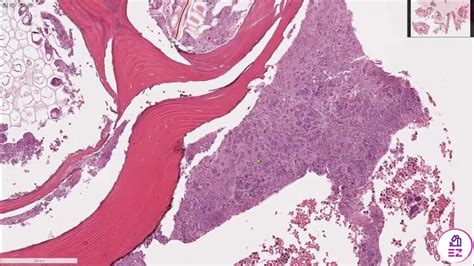 Bony Sequestrum Youtube