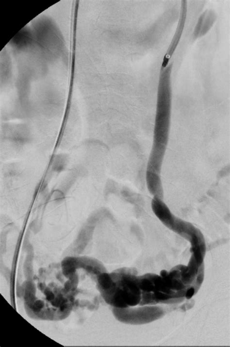 Pelvic Congestion Syndrome Pcs Treatment In Cary