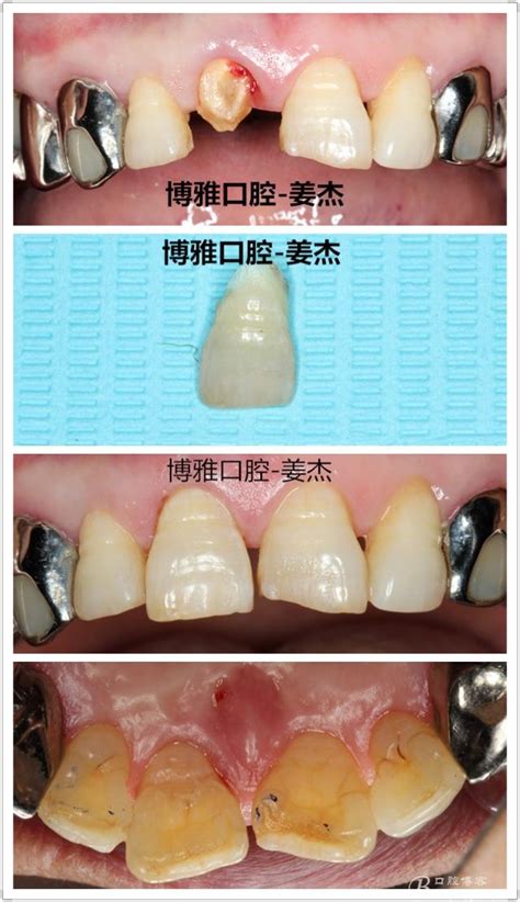 外伤冠折病例一 博雅口腔 姜杰的博客 Kq88口腔博客 外伤冠折病例一 博雅口腔 姜杰的博客 Kq88口腔博客