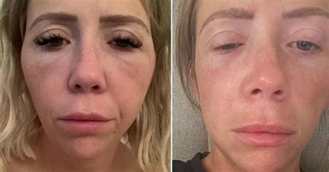 다들 받는 시술인데… 부작용으로 결혼까지 미룬 여성 무슨 일