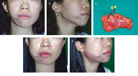 Figure 1 From Surgical Management Of Localized Scleroderma Semantic Scholar