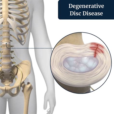 Degenerative Disc Disease Treatment In Irving Tx And Dallas Tx
