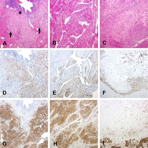 Adenomyosis Associated Perivascular Epithelioid Cell Tumor Pecoma
