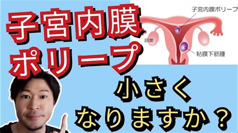 【子宮内膜ポリープ】手術でとる以外に治す方法はありますか？ Youtube