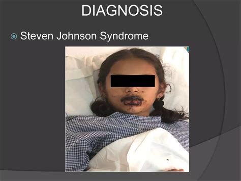 Adverse Drug Reaction Steven Johnson Syndrome Pptx