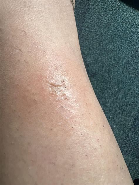 Spider Bites Rspiderbites