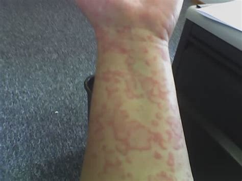 Relief For Hives Skin Hives