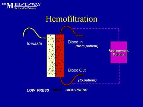 Hemofiltration Arteriovenous Hemofiltration Cavh Hemofiltration