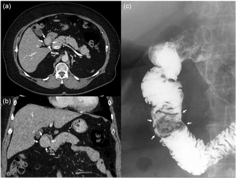Computed Tomography And Duodenography Findings Enhanced Computed
