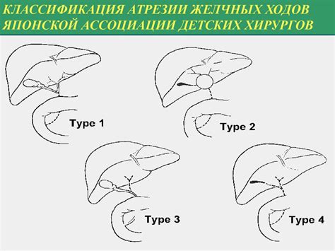 Пороки развития желчных путей Online Presentation