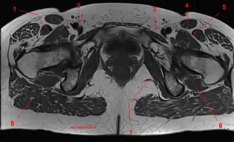 Mri Of The Hip Detailed Anatomy W Radiology