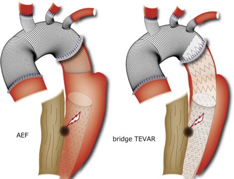 Surgical Strategy For The Treatment Of Aortoesophageal Fistula The