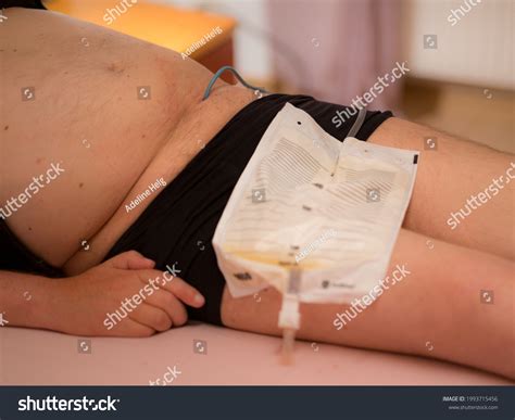 Suprapubic Catheter Female