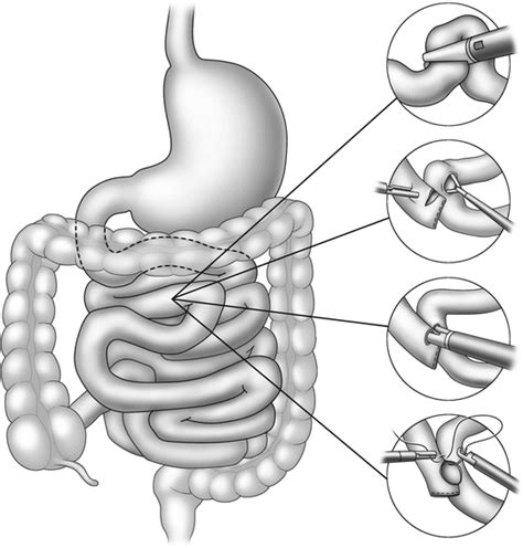 Laparoscopic Gastric Bypass Technique And Outcomes Plastic Surgery Key