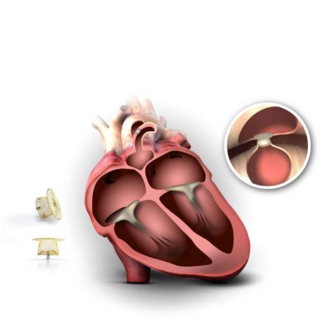 Heart Defect Pda Occlutech Every Beat Counts