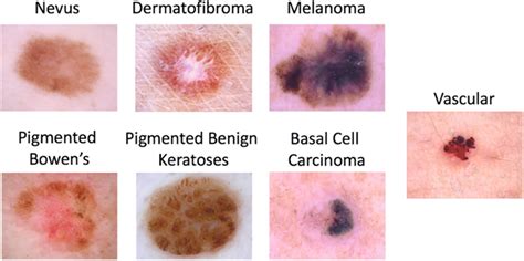 Random Sample From Seven Classes Of ISIC Dataset Download Scientific Diagram