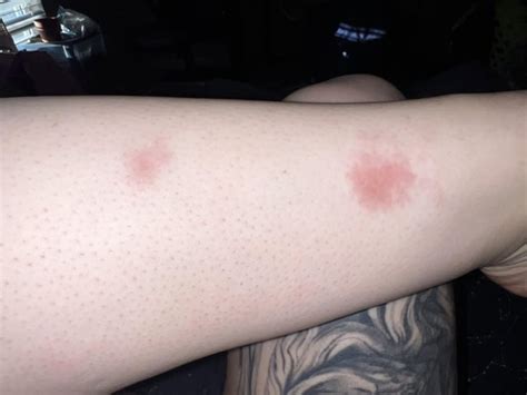 Granuloma Annulare Derm Suspects It Waiting On Biopsy R