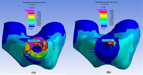 Equivalent Stress Distributions At The Fracture Site On A Lower Part Of