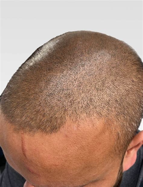 Smp Options His Hair Clinic
