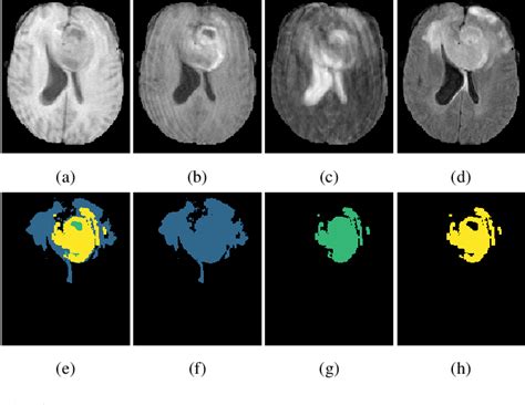 Pseudo Label Refinement Using Superpixels For Semi Supervised Brain Tumour Segmentation