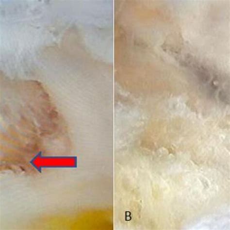 Diagnostic Arthroscopy Of Right Proximal Tibia A Bony Irregularities Download Scientific