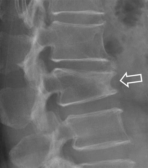 Vertebral Fracture Identification Oncohema Key